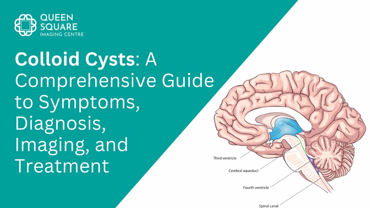 Colloid Cysts: A Comprehensive Guide to Symptoms, Diagnosis, Imaging ...