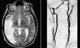 MRI Perfusion Imaging in Stroke - Queen Square Imaging Centre