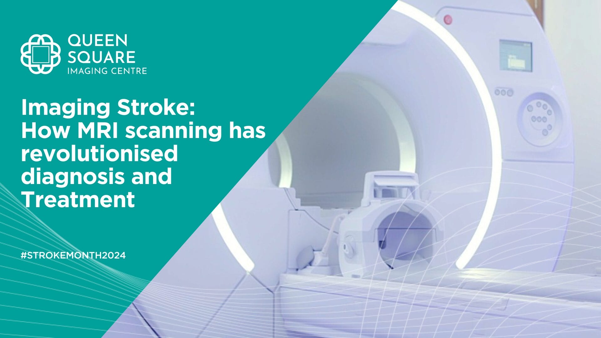 Imaging Stroke: How MRI scanning has revolutionised diagnosis and Treatment - Queen Square ...
